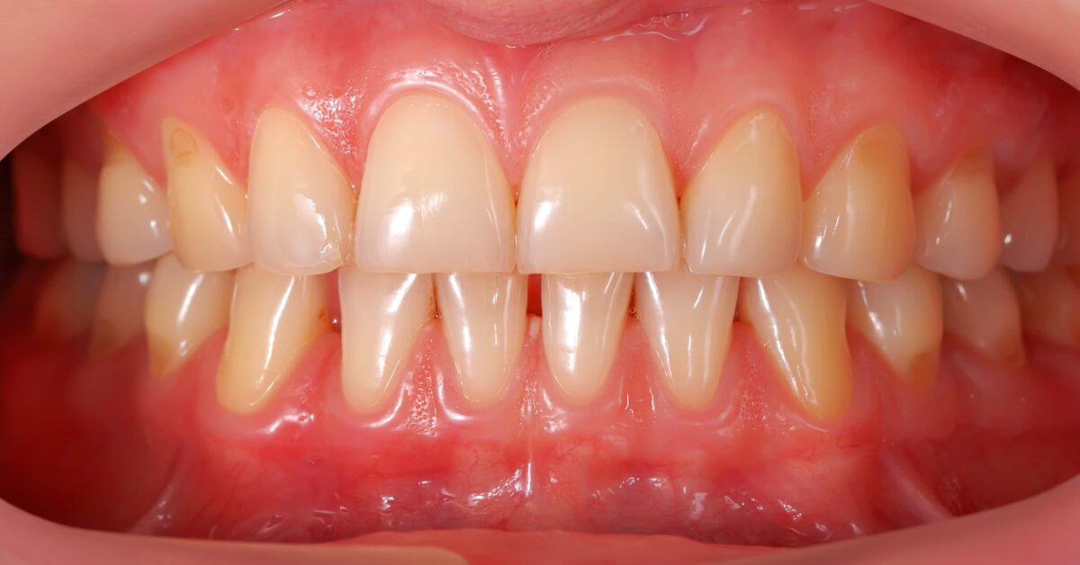 Experiencing Gum Inflammation? Try Scaling and Root Planing | Baxter, MN