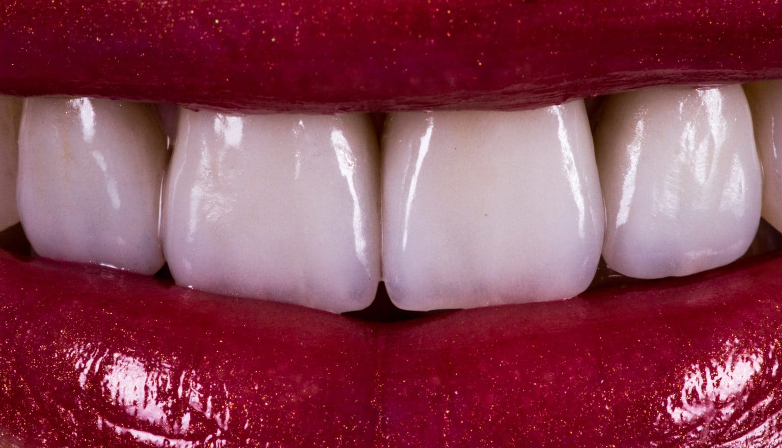 Using Dental Crowns for Cosmetic Improvement | Baxter, MN